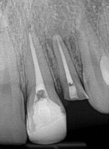Restoring Anterior Trauma With Root Submergence: Maintaining the ...