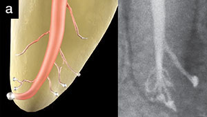 Filling Root Canal Systems: A Carrier-Based Obturation Method ...
