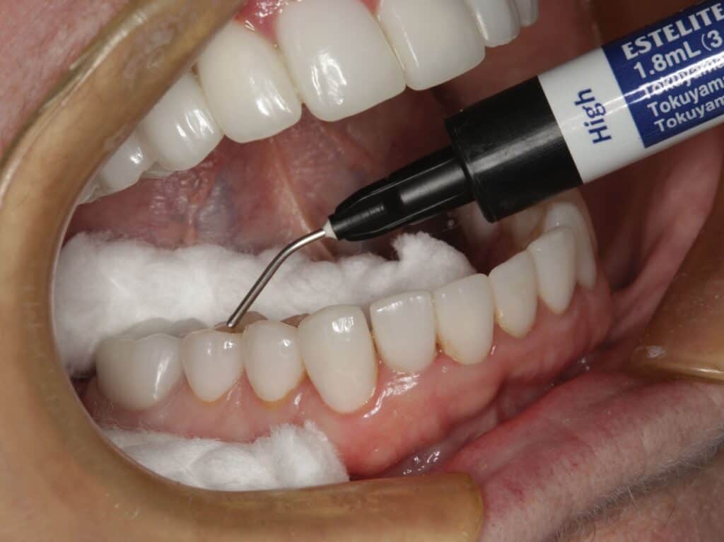 Estelite Universal Flow: A Truly 'Universal' Restorative Material ...