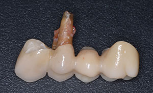 Laser-Assisted Techniques Increase Efficiency and Comfort - Dentistry Today