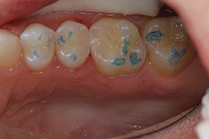 The Direct Bulk-Fill Restorative Option - Dentistry Today