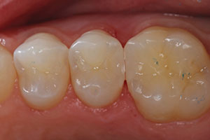 The Direct Bulk-Fill Restorative Option - Dentistry Today