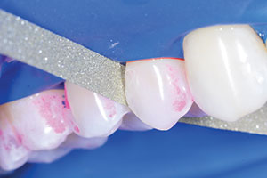 Modern Cavity Preparations - Dentistry Today