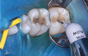 Leveraging the ABCs of Composites: Adhesion, Bulk-Filling, and Curing ...