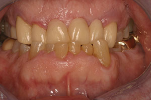 Phasing Complex Cases When Opening the VDO - Dentistry Today