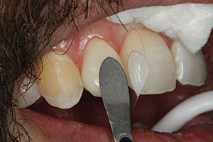 Direct Resin Veneer Technique: Using A Single-Shade Composite ...