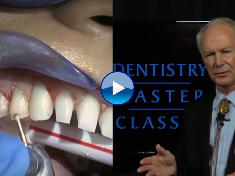 How to Prep Porcelain Veneers - Dentistry Today