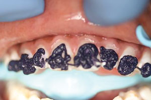 Treating White Spot Lesions: Protocol for a Professionally Dispensed ...