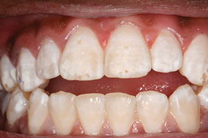 Treating White Spot Lesions: Protocol for a Professionally Dispensed ...