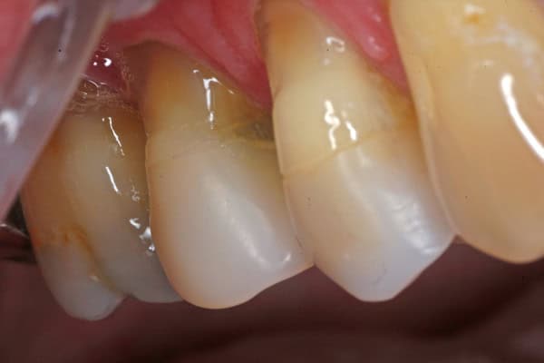 The Indirect Resin Nano-Ceramic Restoration - Dentistry Today
