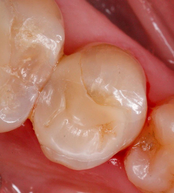 The Indirect Resin Nano-Ceramic Restoration - Dentistry Today