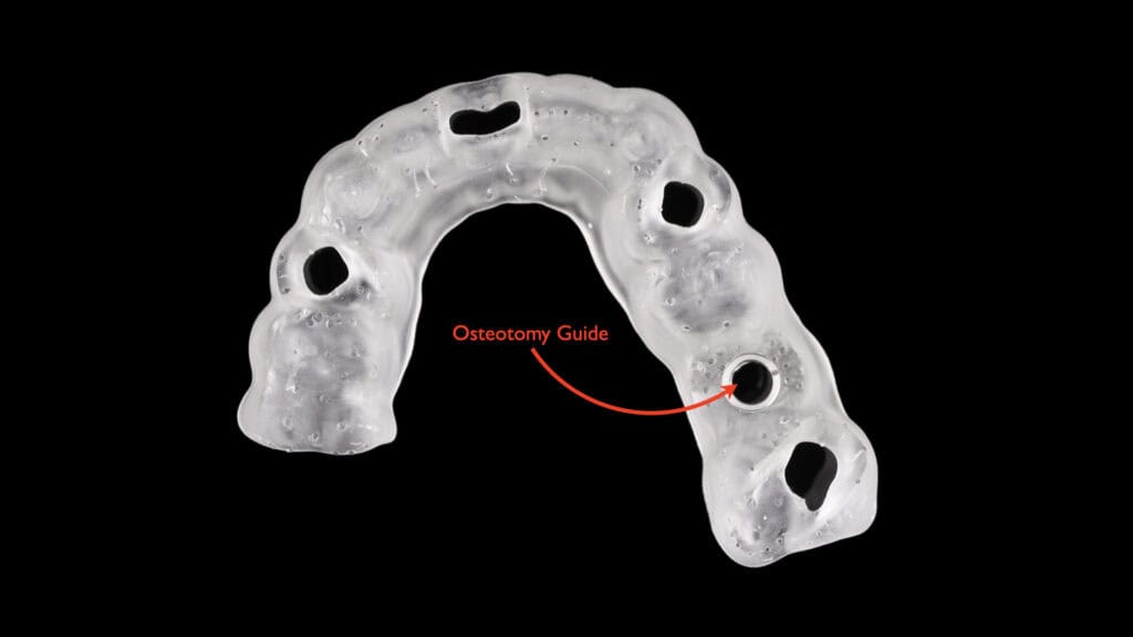 A Comprehensive Classification System for Dental Implant Surgical ...