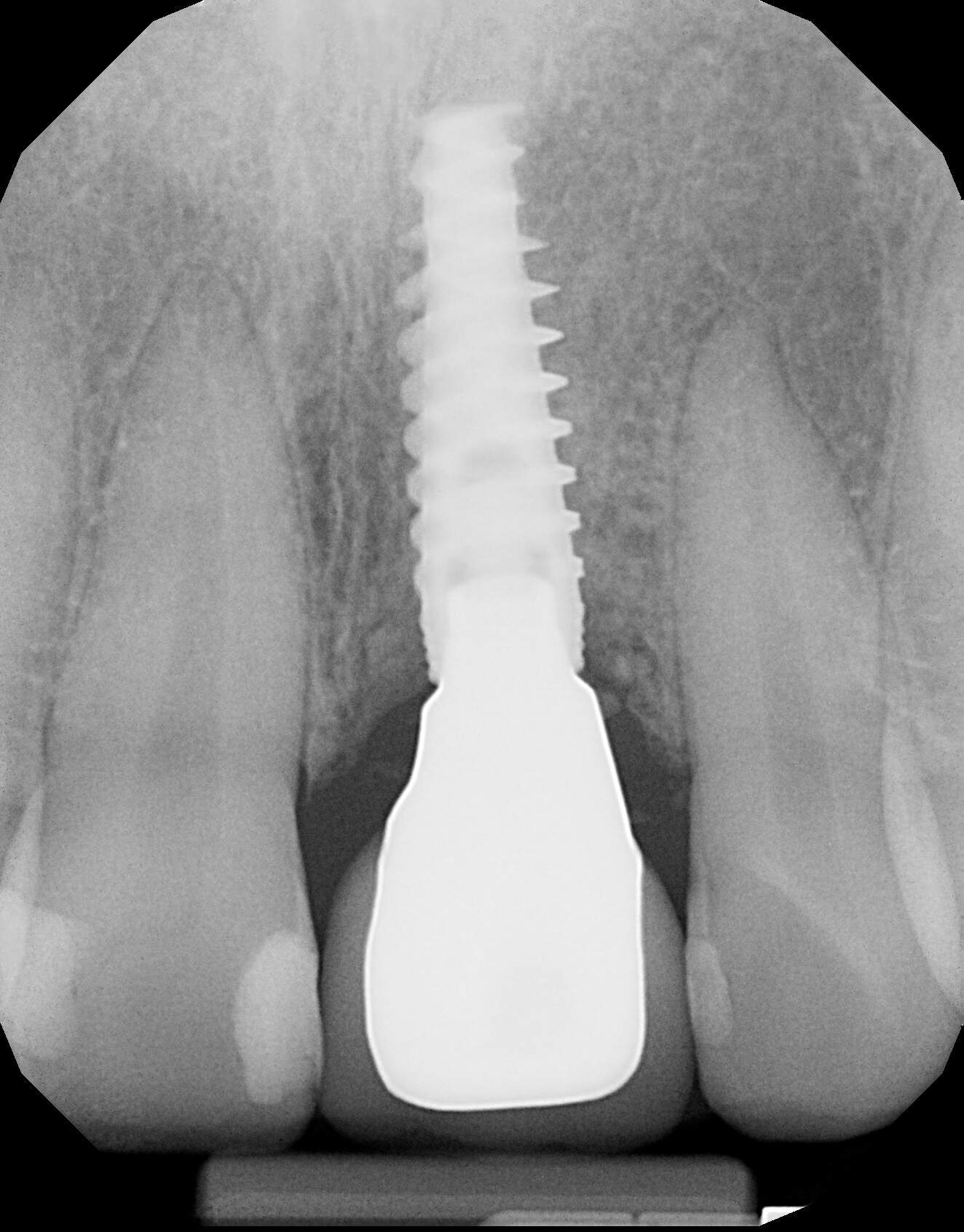 A Roadmap to Success in Managing Early to Severe Peri-implantitis ...