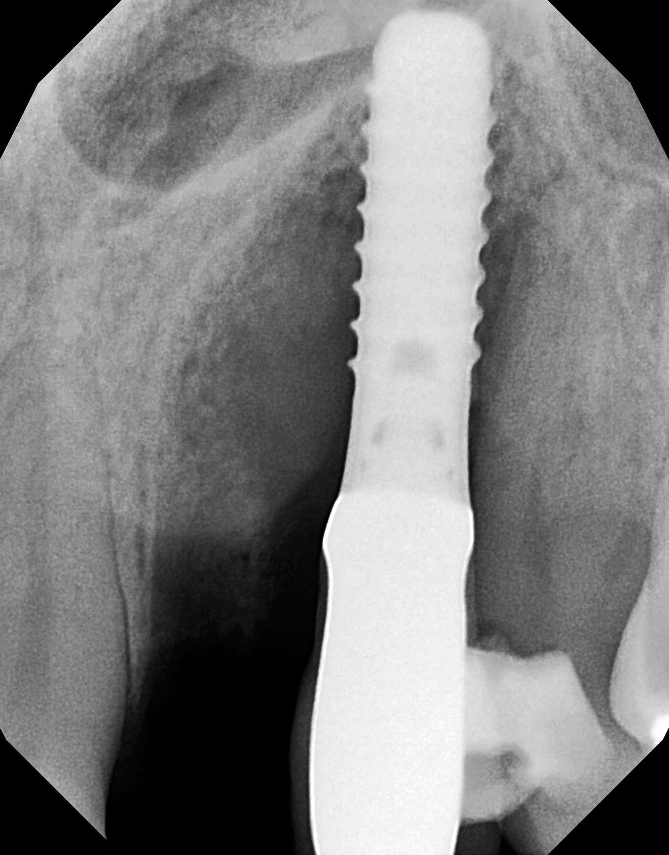 A Roadmap to Success in Managing Early to Severe Peri-implantitis ...