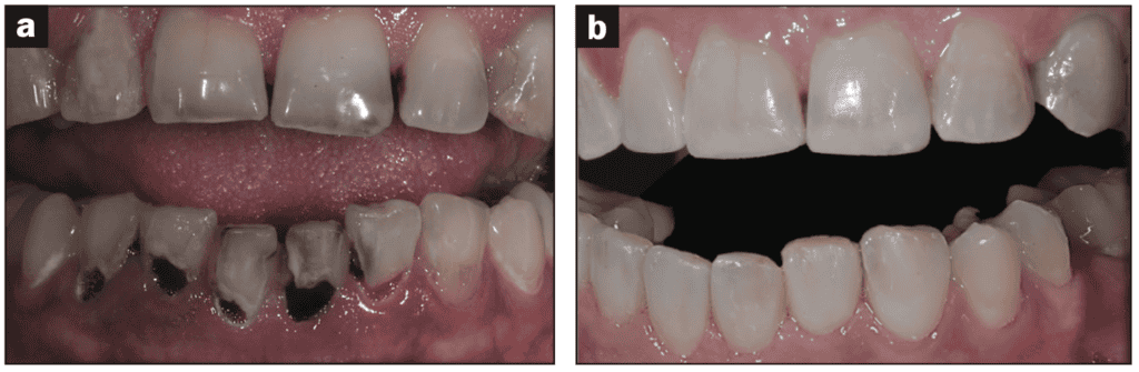 Use of Minimally Invasive Techniques and Antimicrobial Agents to Treat ...