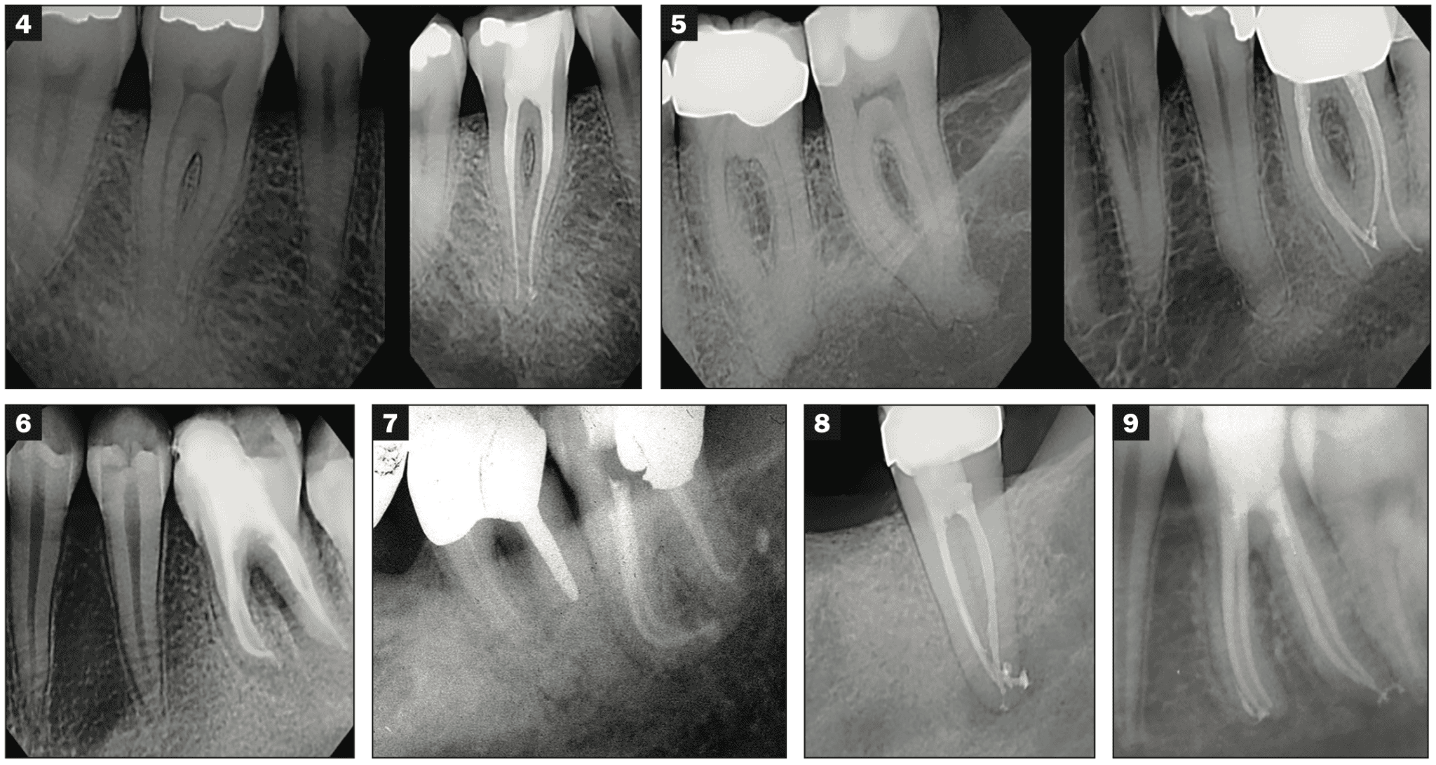 Common Sense Insights Into Present-Day Endodontic Instrumentation ...