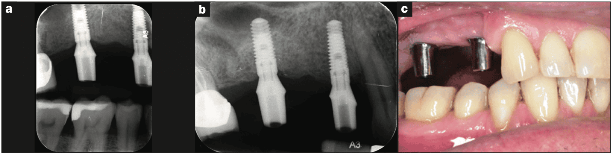 Using Dentin Grafting in Early Implant Placement With Vertical Sinus ...