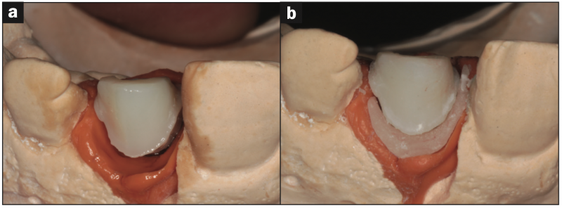 Modified Emergence Profile of a Maxillary Central Incisor Implant