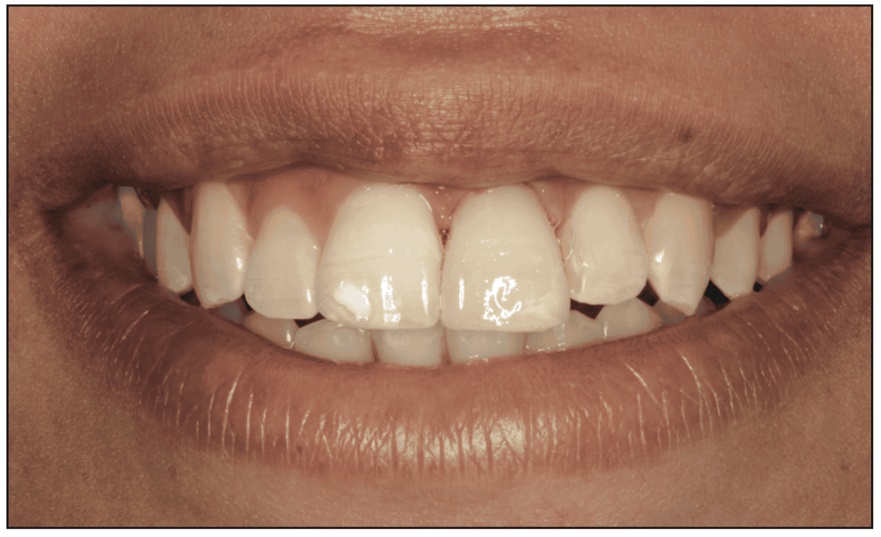 Modified Emergence Profile of a Maxillary Central Incisor Implant ...