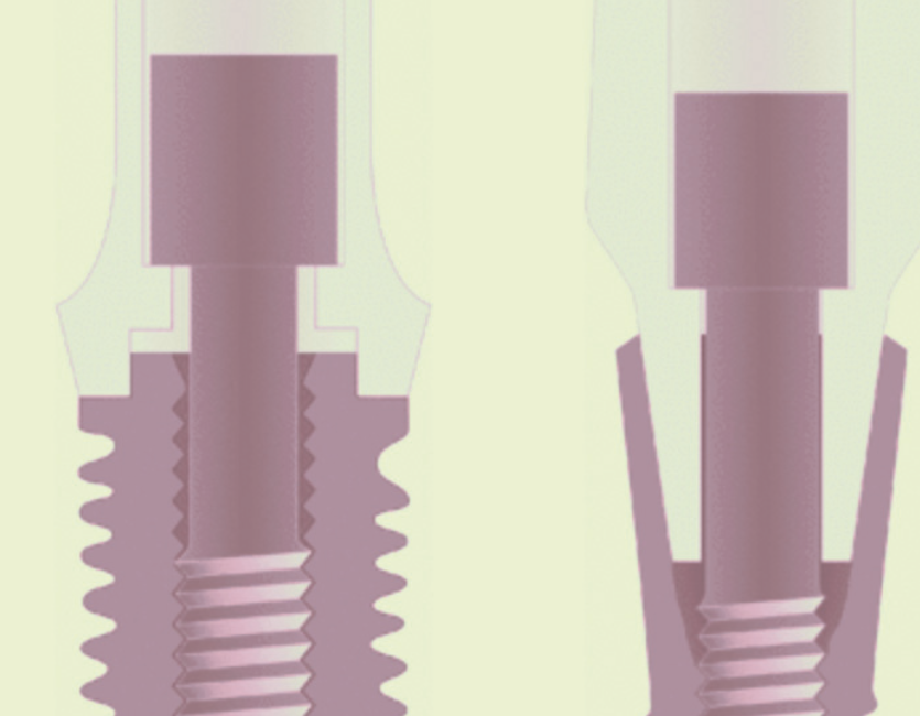 Demystifying Implant Connections - Dentistry Today