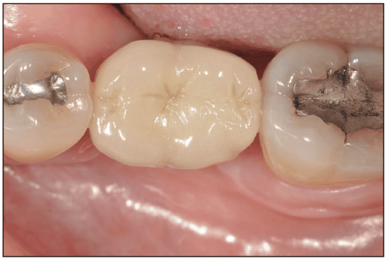 Retrieve and Recommission a Cement-Retained Crown With a Loose Abutment ...