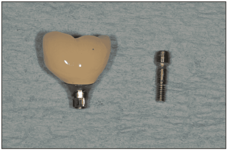 Retrieve and Recommission a Cement-Retained Crown With a Loose Abutment ...