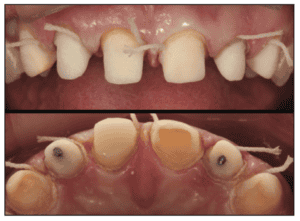 Posts and Core Buildups in the 21st Century - Dentistry Today