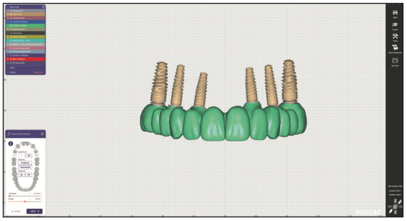 Full-Arch Surgery With No Prosthesis to Convert: Using Photogrammetry ...