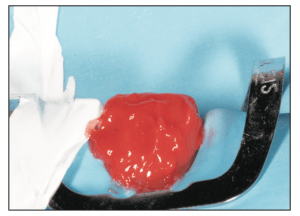 Leveraging the Inside-Outside Bleaching Technique - Dentistry Today