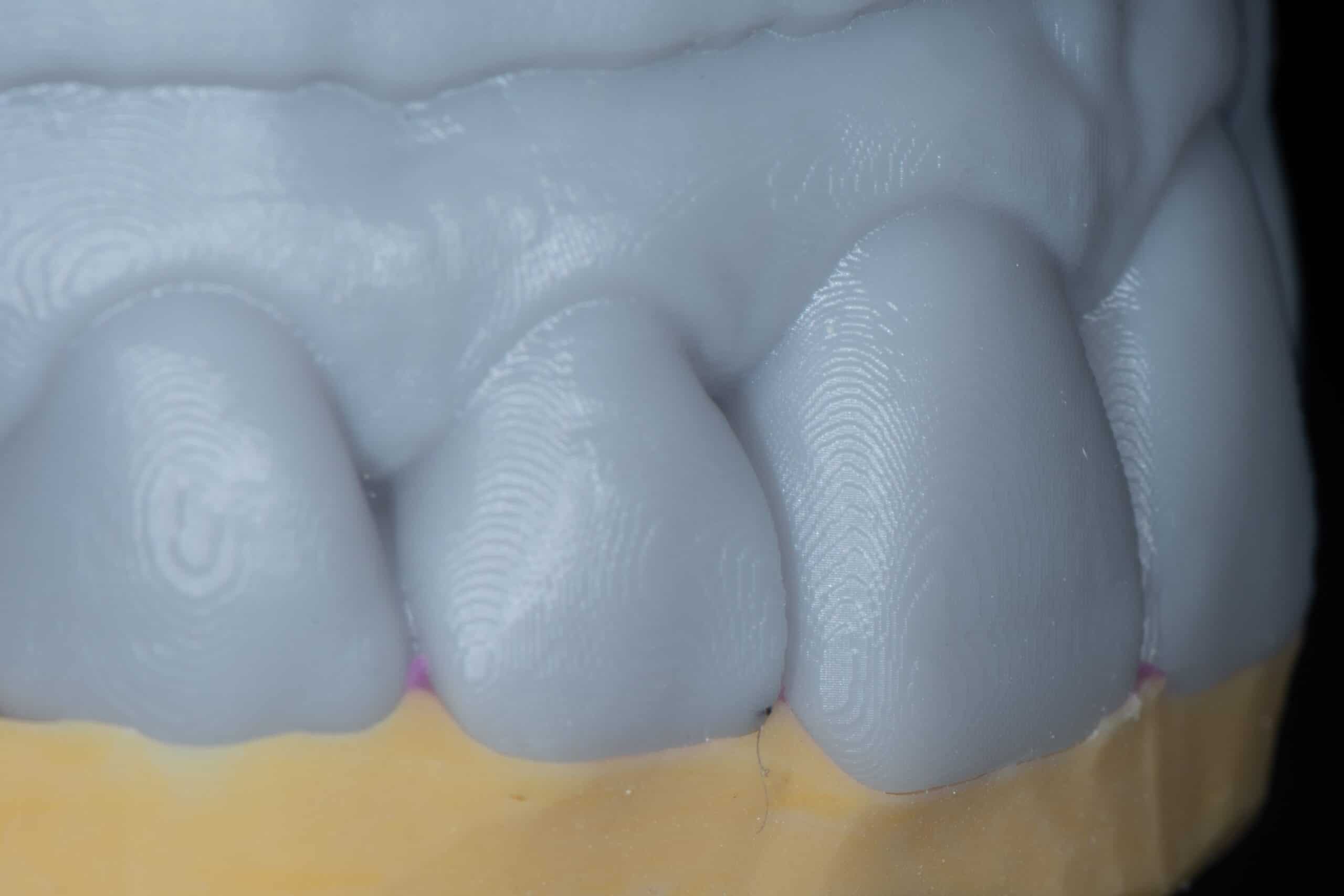 Direct Composite Restorations in the Asthetic Zone - Dentistry Today