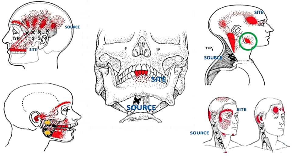 Laser Therapy for TMJ Problems to Improve Comfort and Mobility ...