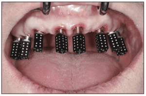 Intraoral Photogrammetry: The Next Step in Full-Arch Implant Precision ...