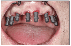 Intraoral Photogrammetry: The Next Step in Full-Arch Implant Precision ...