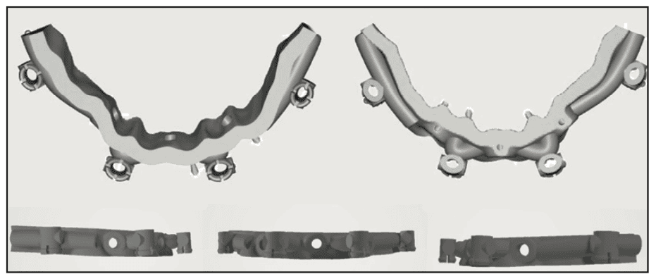 Full-Arch Implant Rehabilitation: Virtual Planning to Implant Placement ...