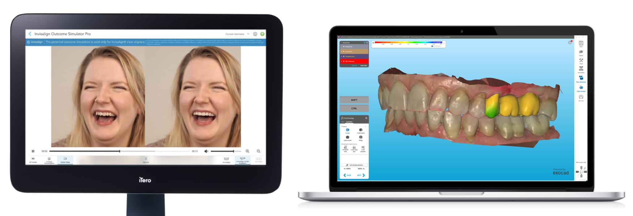 Align Technology Launches new iTero Digital Solutions - Dentistry Today