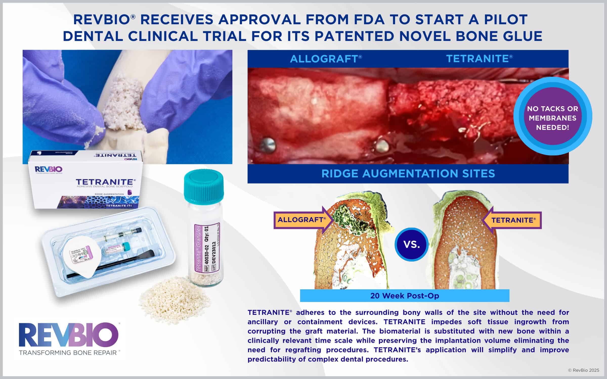 RevBio Advances Regenerative Bone Adhesive Trial - Dentistry Today