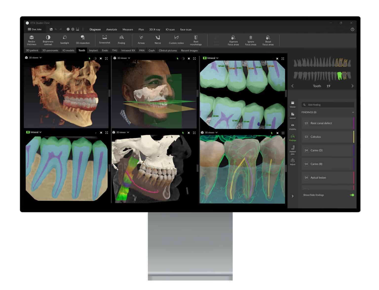 DEXIS Unveils Advanced AI Imaging Update - Dentistry Today