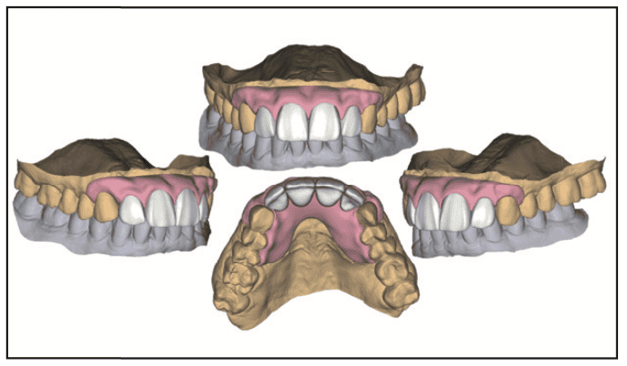 In-Office Fabrication of Flexible Partial Dentures Using a New Base ...